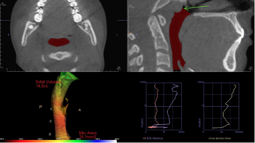 Sleep Medicine and Airway Investigation – Pearl CBCT – Dr. Morvarid ...