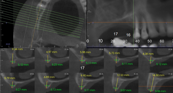 Implant Offices CBCT Imaging – Pearl CBCT – Dr. Morvarid Poorsattar