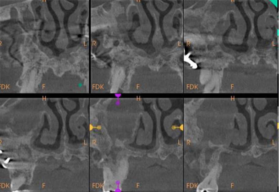 Sinus Evaluation – Pearl CBCT – Dr. Morvarid Poorsattar