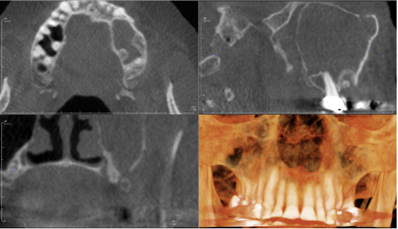 Sinus Evaluation – Pearl CBCT – Dr. Morvarid Poorsattar