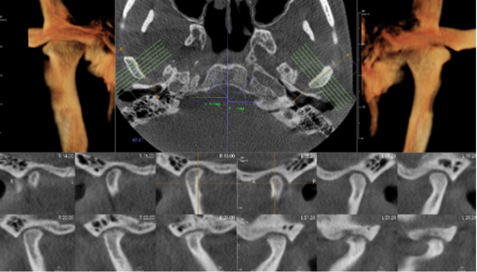 Temporomandibular joint investigation – Pearl CBCT – Dr. Morvarid ...
