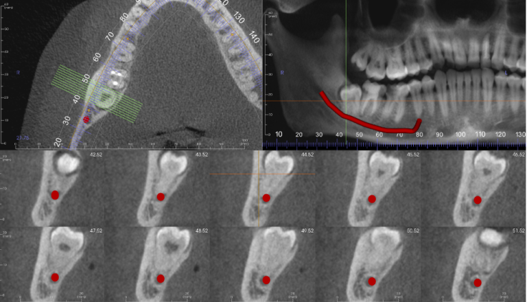 Oral Surgery – Pearl CBCT – Dr. Morvarid Poorsattar