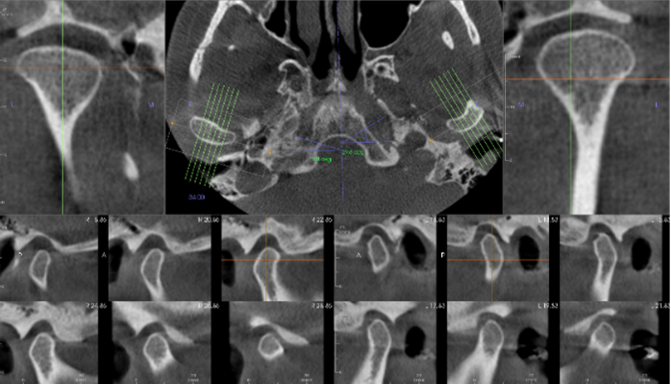 Temporomandibular joint investigation – Pearl CBCT – Dr. Morvarid ...